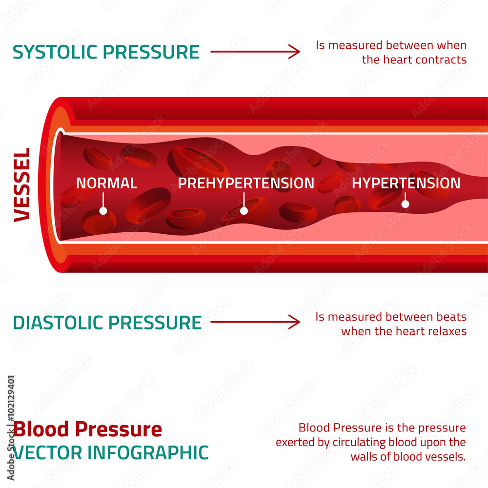 Blood Pressure Infographic Stock Vector | Adobe Stock