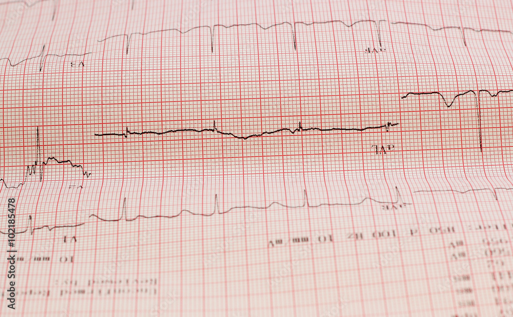Ecg graph, electrocardiogram ecg Stock Photo | Adobe Stock
