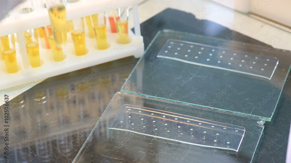 Quantitative determination of immunoglobulins in blood serum by radial ...
