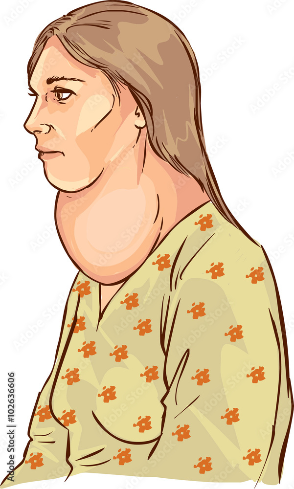 Poster white backround Vector illustration of a goiter – Wall Art ...