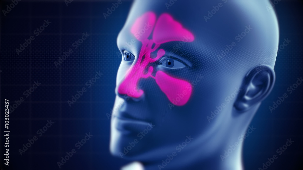 Nasal Sinus Infection Cured by Medicne. Frontal, Ethmoidal, Sphenoidal ...