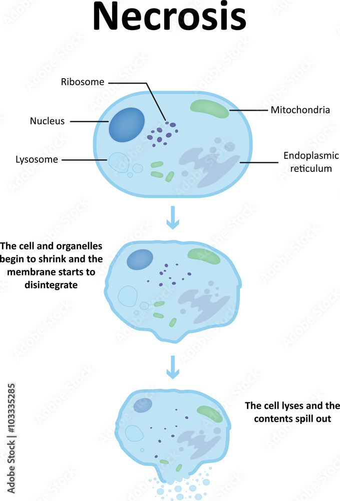 Necrosis Diagram Stock Illustration | Adobe Stock