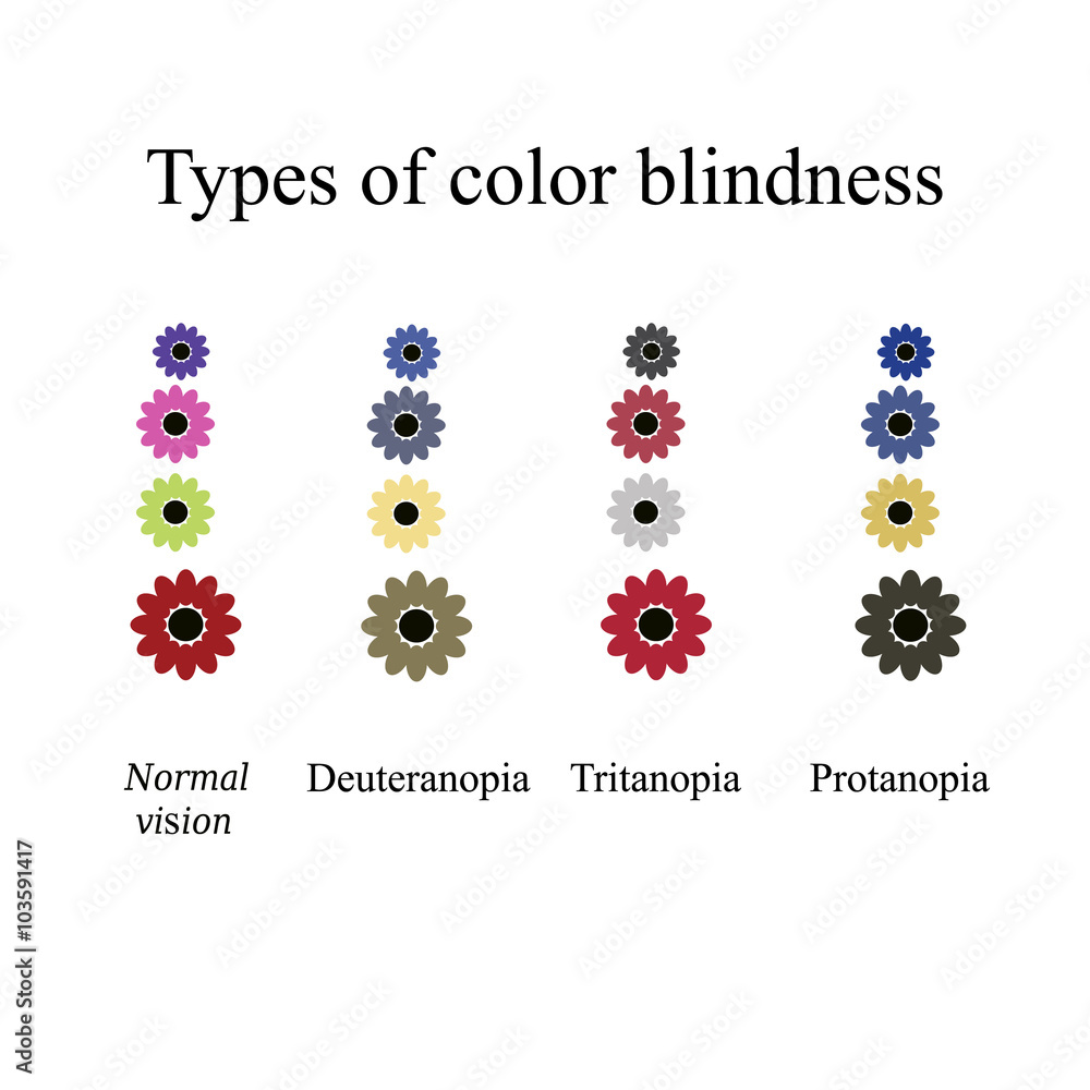 Types of color blindness. Eye color perception. Vector illustration on ...