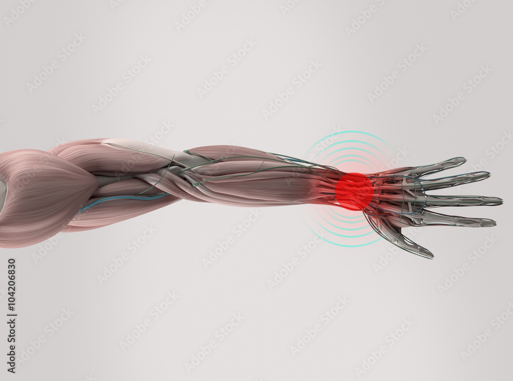 Anatomy model showing wrist pain. On plain studio background. Stock ...