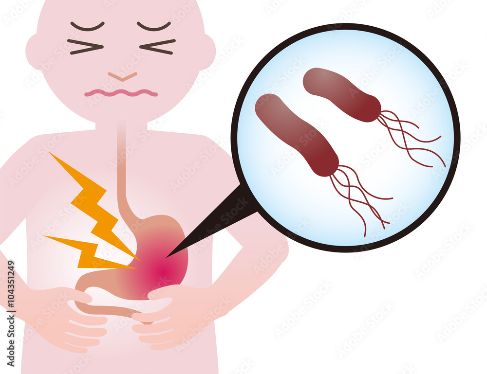 human stomach and Helicobacter pylori, stomach ache, gastric ulcer ...