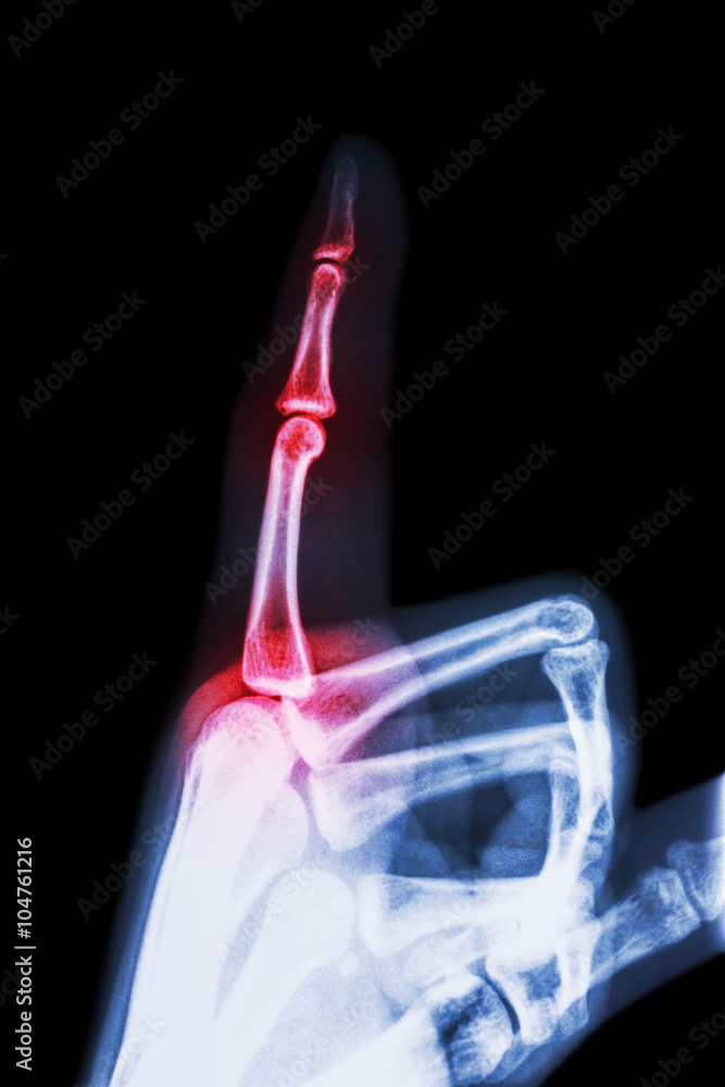 Rheumatoid arthritis , Gouty arthritis ( film x-ray index finger and ...
