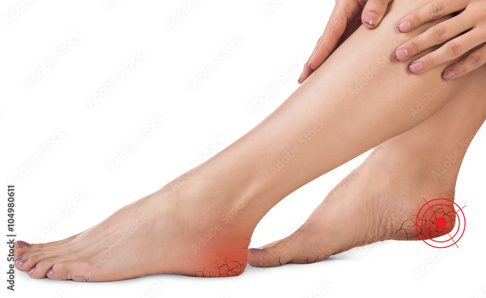 Female legs with cracks Stock Photo | Adobe Stock