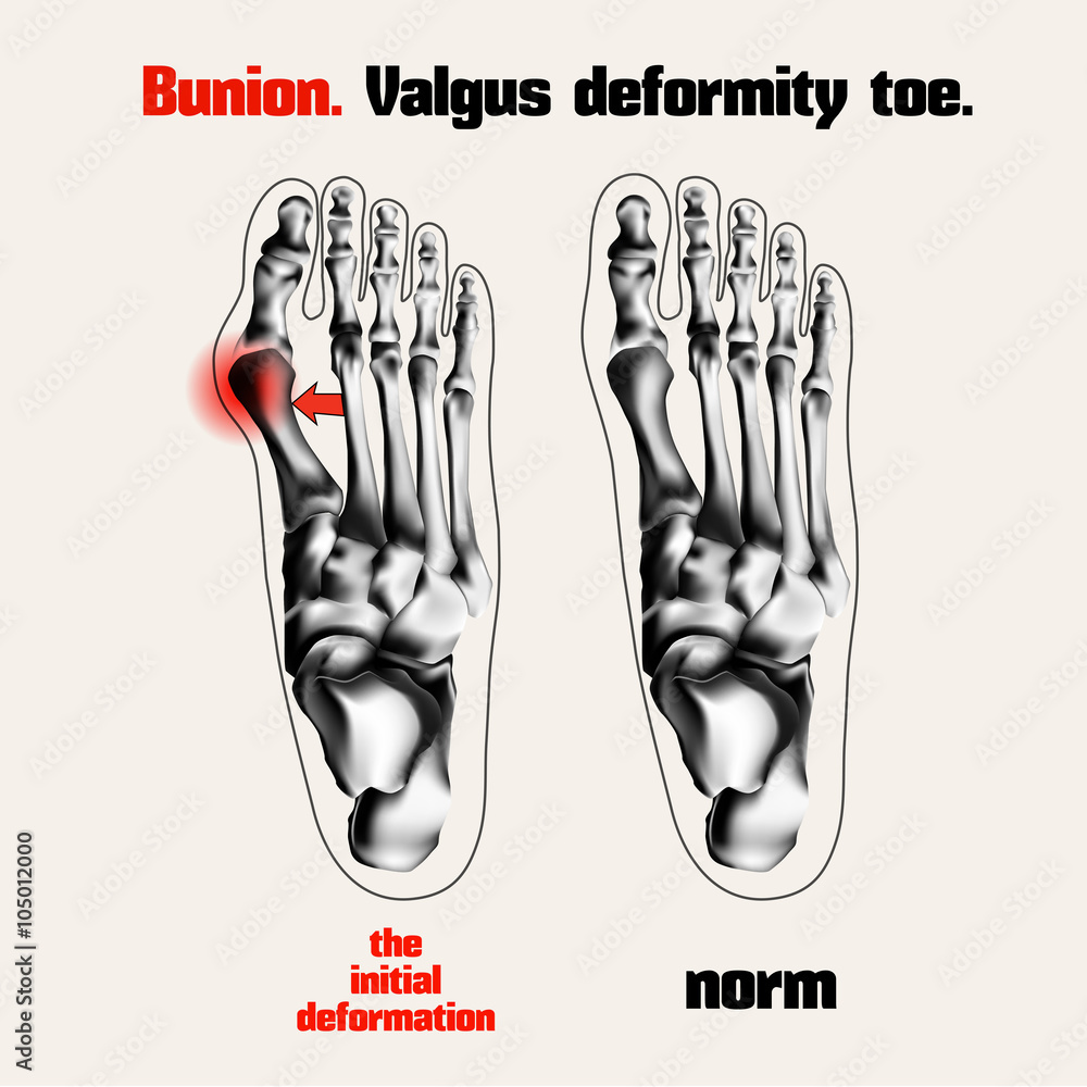 Bunion. Valgus deformity toe. Stock Vector | Adobe Stock