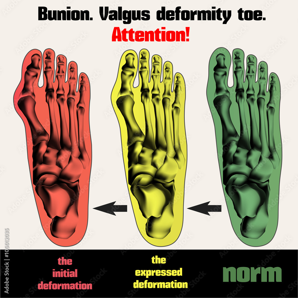Bunion. Valgus deformity toe. Stock Vector | Adobe Stock