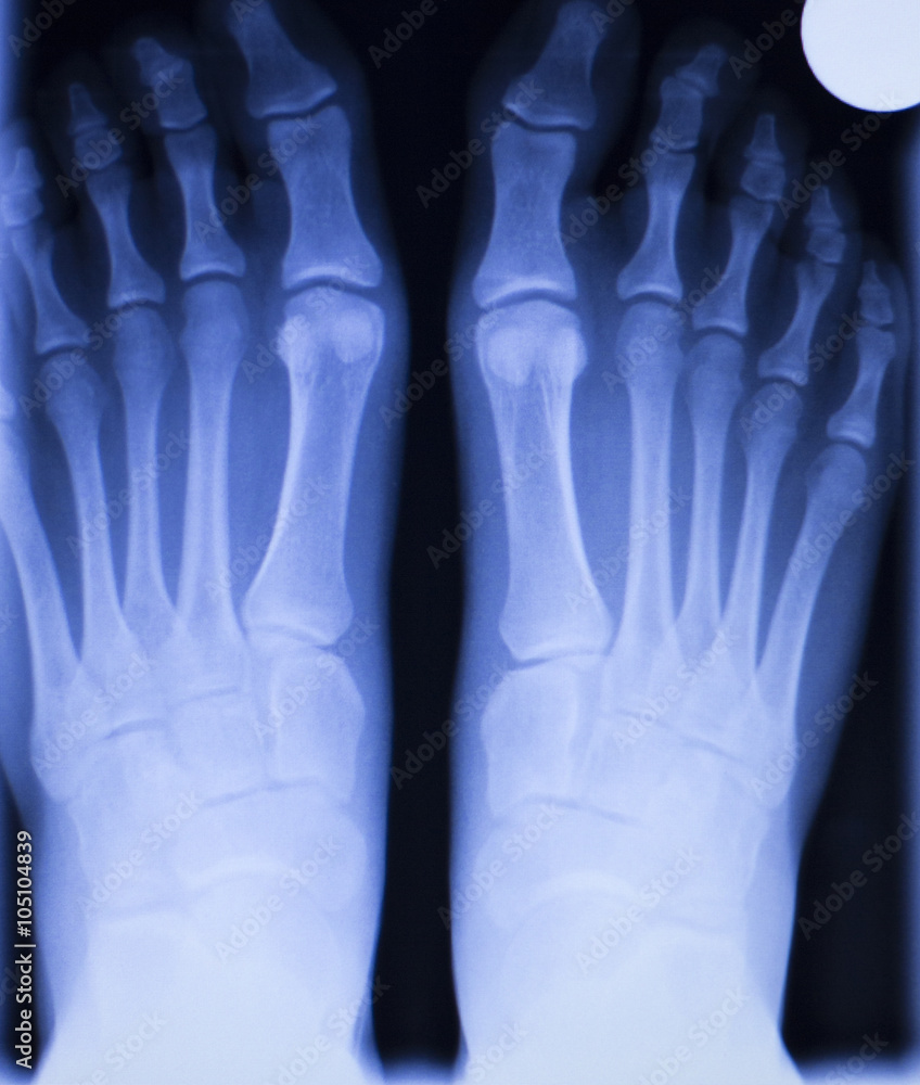 Foot and toes injury xray scan Stock Photo | Adobe Stock