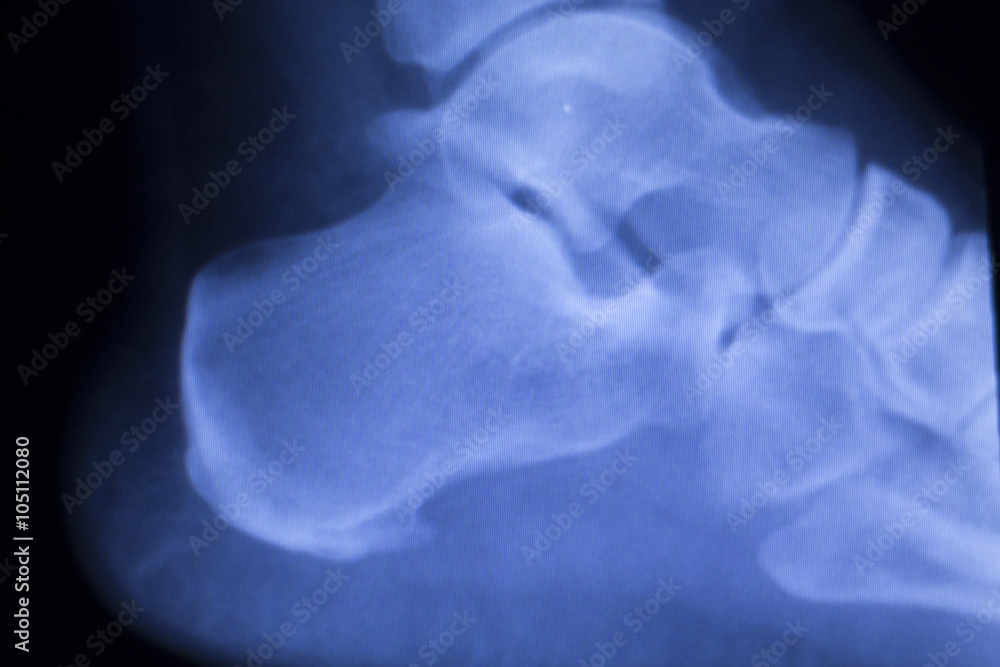 Foot heel ankle injury xray scan Stock Photo | Adobe Stock