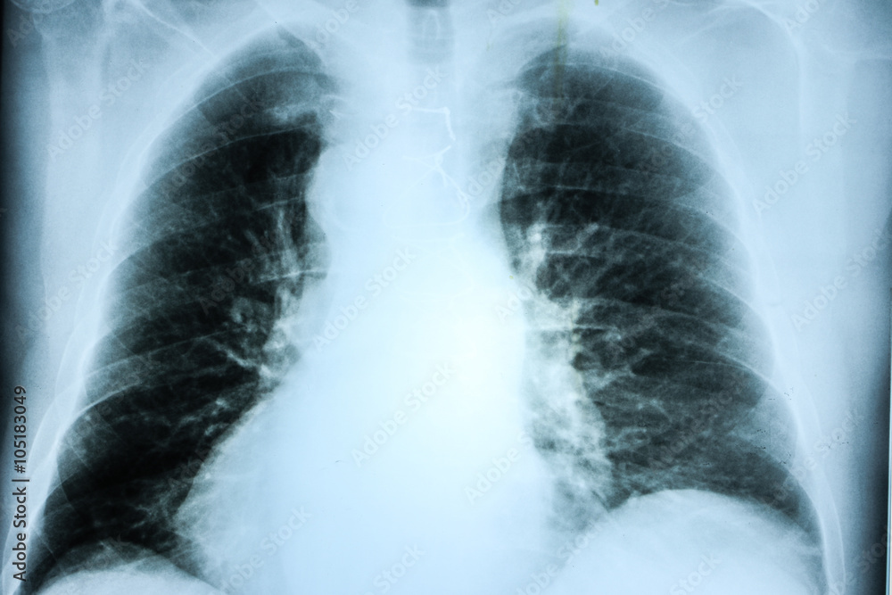 Röntgenaufnahme Thorax Brustkorb Stock Photo | Adobe Stock