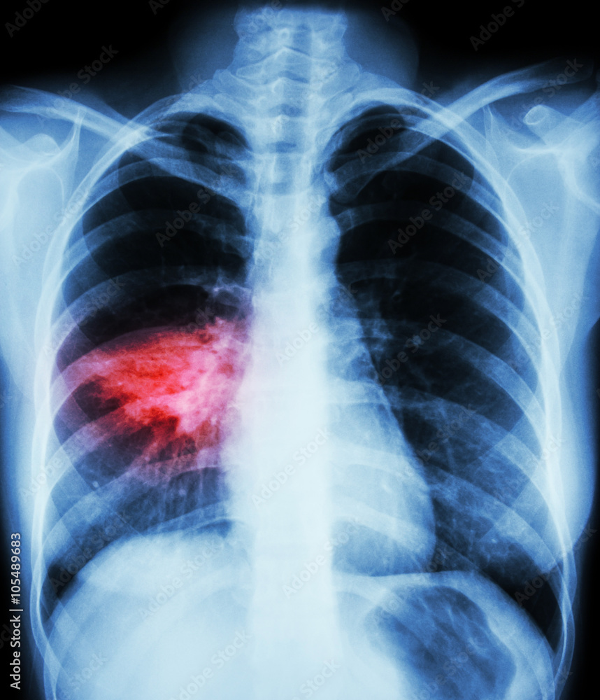 Pneumonia ( film chest x-ray show alveolar infiltrate at right middle ...