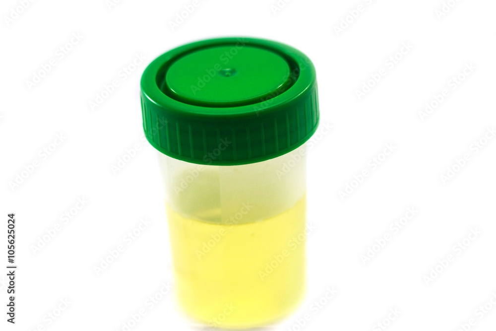 Urine specimen for urinalysis on white background Stock Photo | Adobe Stock