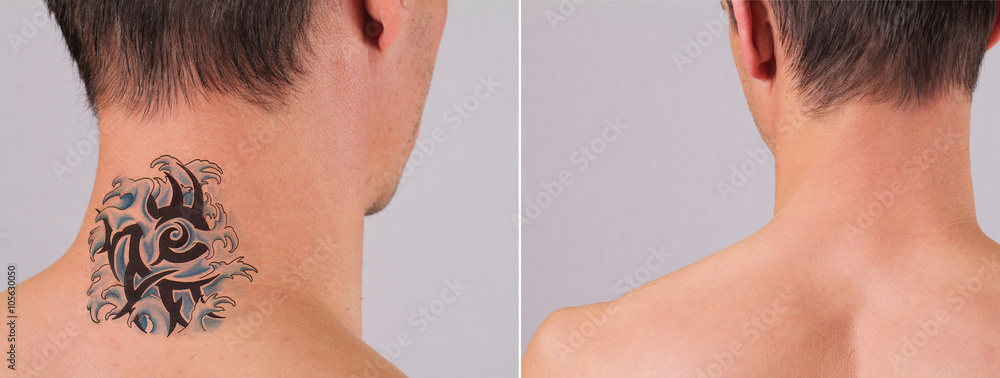 Laser tattoo removal before and after. Attractive Man with tattoo on ...