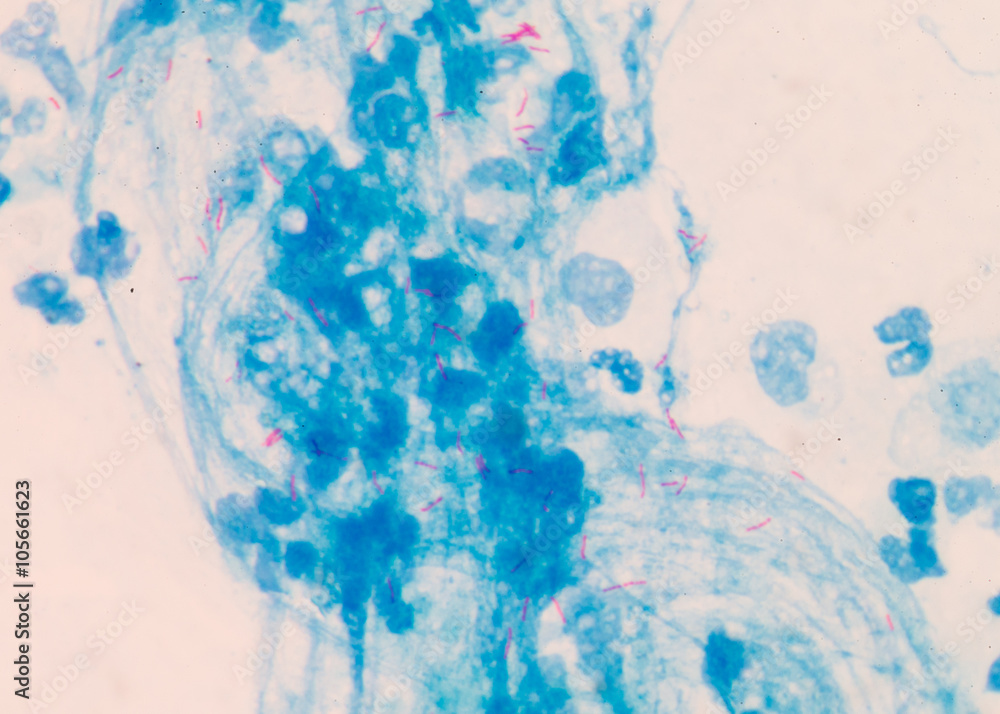 Micro bacterium tuberculosis. Stock Photo | Adobe Stock