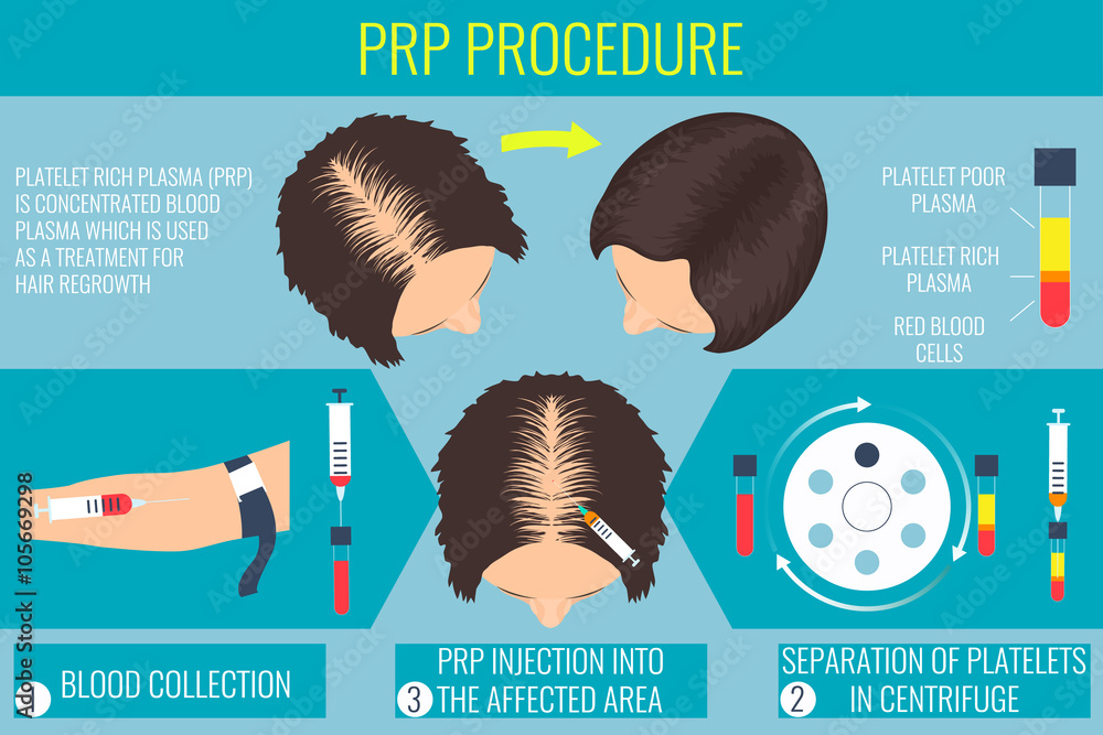 Platelet rich plasma injection. PRP therapy process. Female hair loss treatment infographics ...