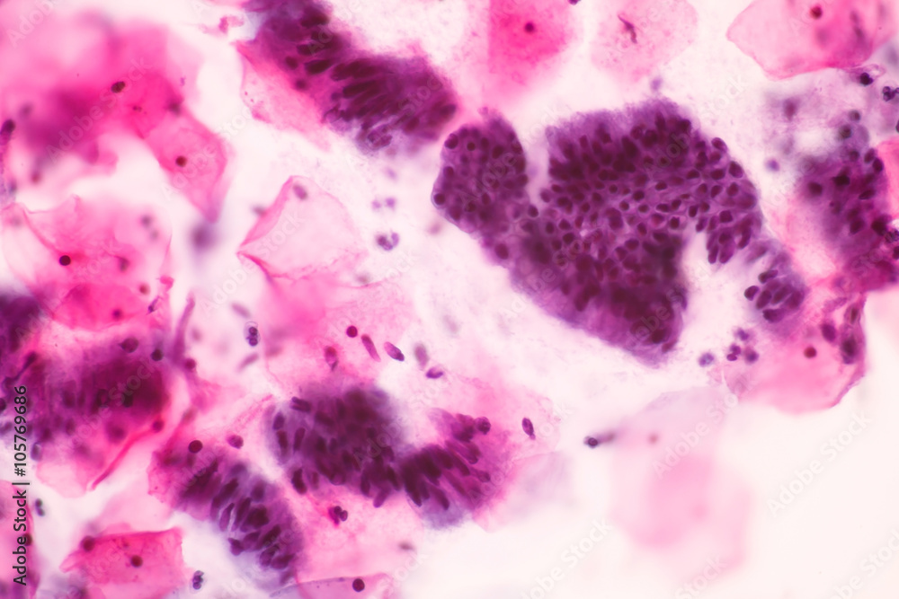 Normal endocervical cells and squamous epithelial cells of cervical ...