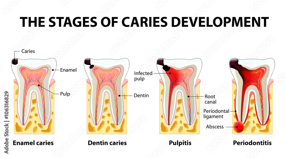 Caries Stages