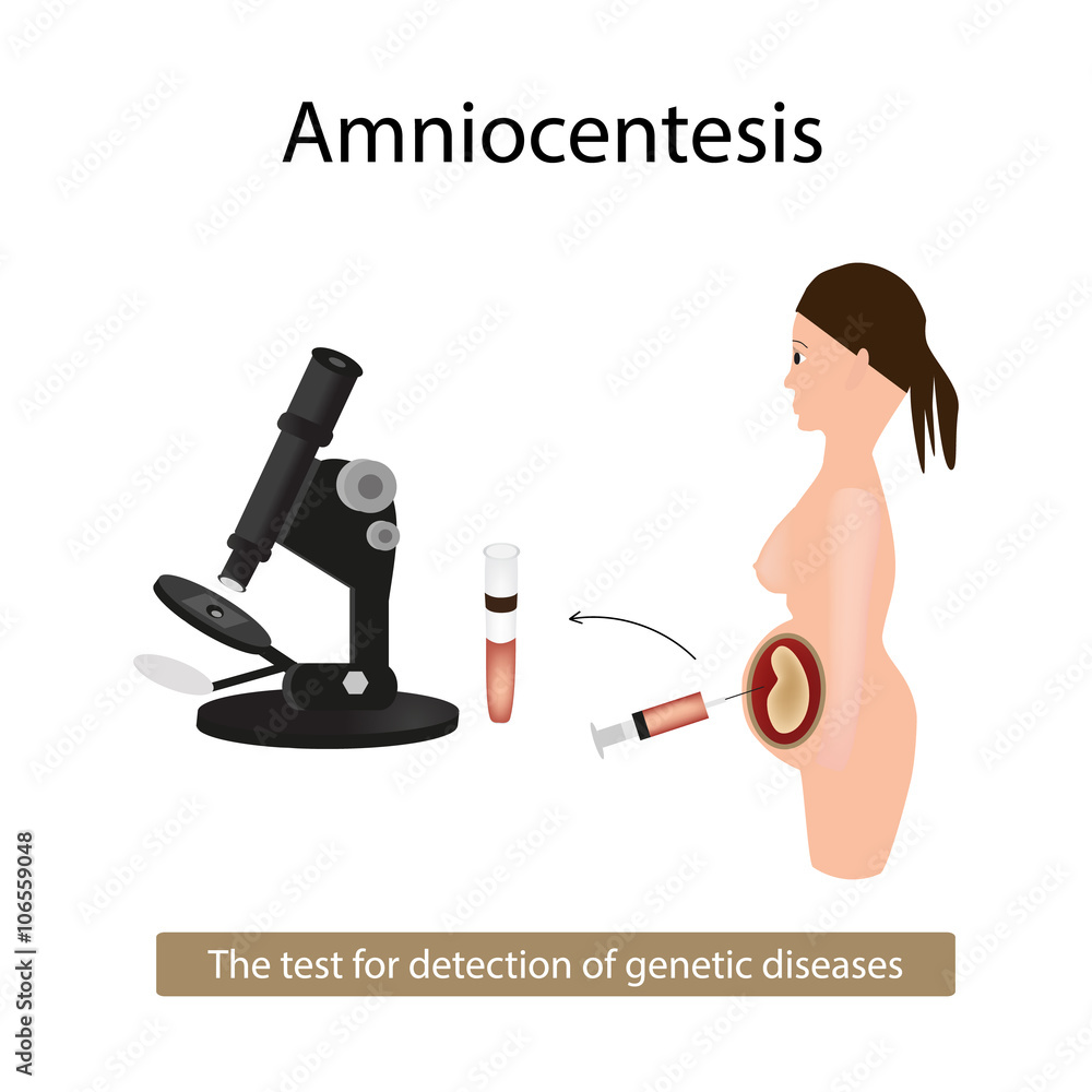 Amniocentesis. Analysis of amniotic fluid. Pregnant woman. Genetic ...