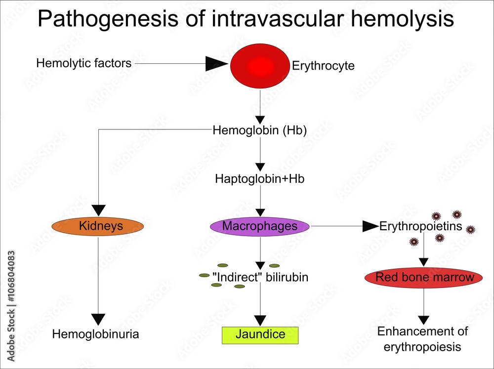Pathogenesis of intravascular hemolysis Stock Vector | Adobe Stock