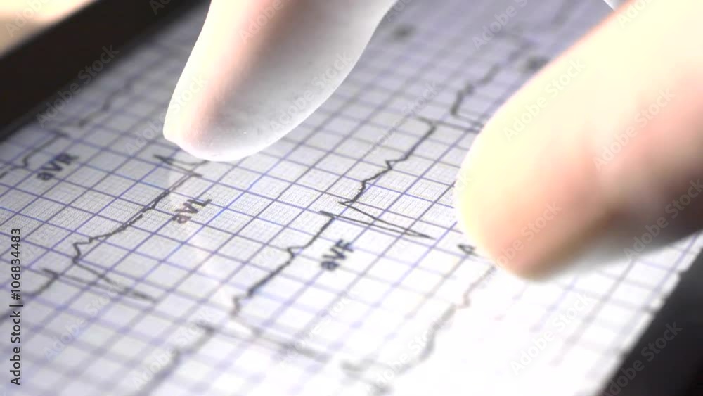 Medicine. Close up examination of an electrocardiogram (EKG or ECG ...