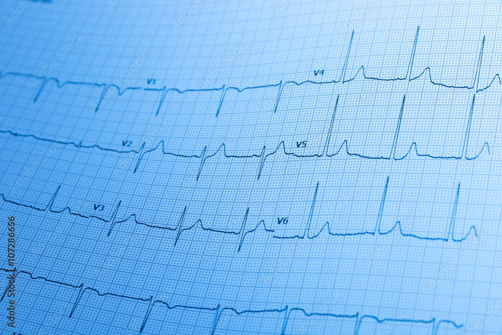 Electrocardiogram / ECG printed on graph paper. A healthy ECG printed ...