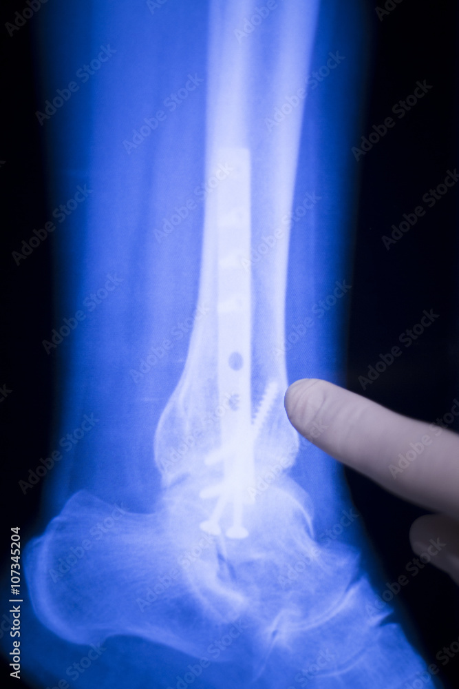 Foot ankle metal implant xray scan Stock Photo | Adobe Stock