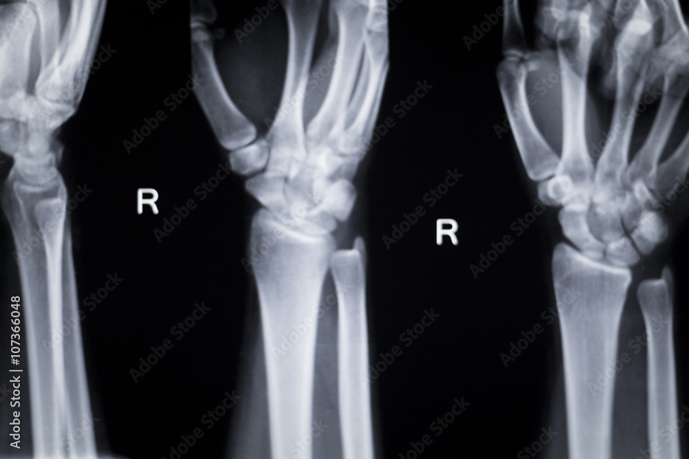 Wrist hand injury xray scan Stock Photo | Adobe Stock