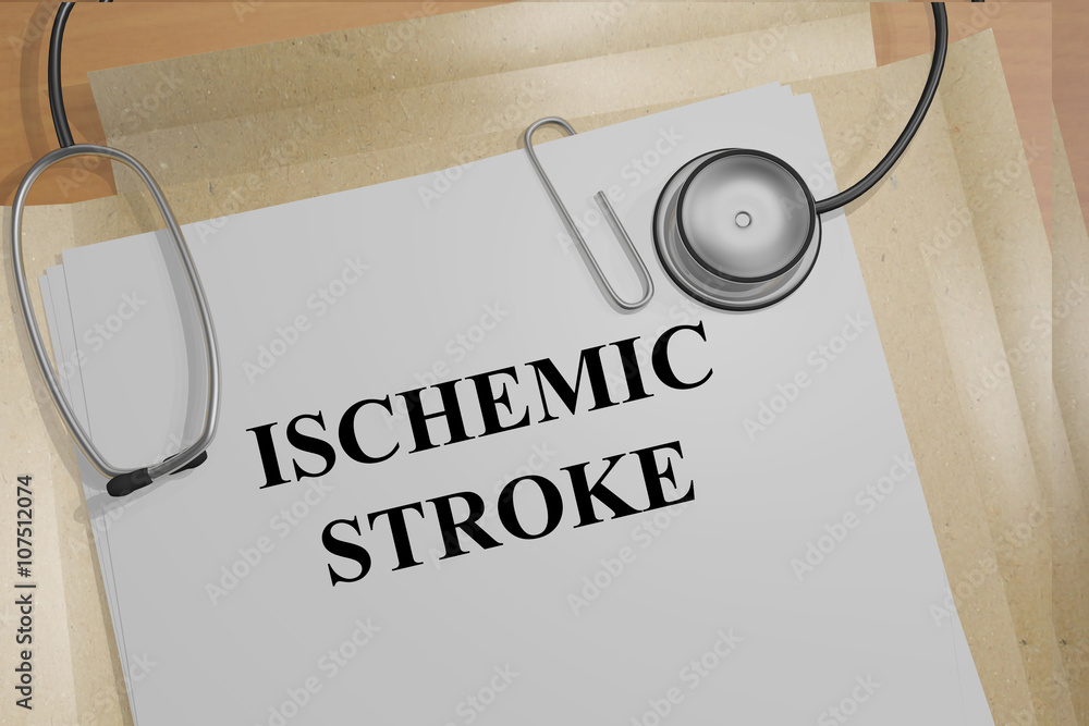 Ischemic Stroke concept Stock Illustration | Adobe Stock