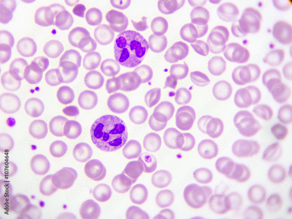 Poster Neutrophil cell (white blood cell) in peripheral blood smear ...