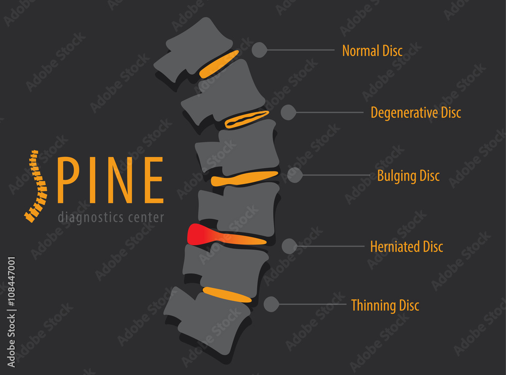 Photo Spine anatomy disc degeneration, medical conceptual infographic ...