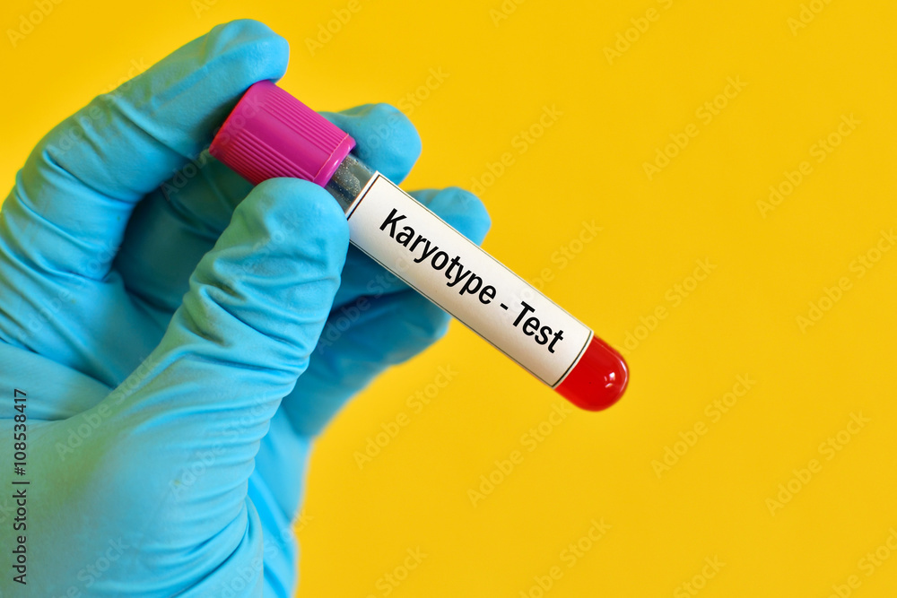 Blood sample for karyotype (abnormal chromosome study) testing Stock ...