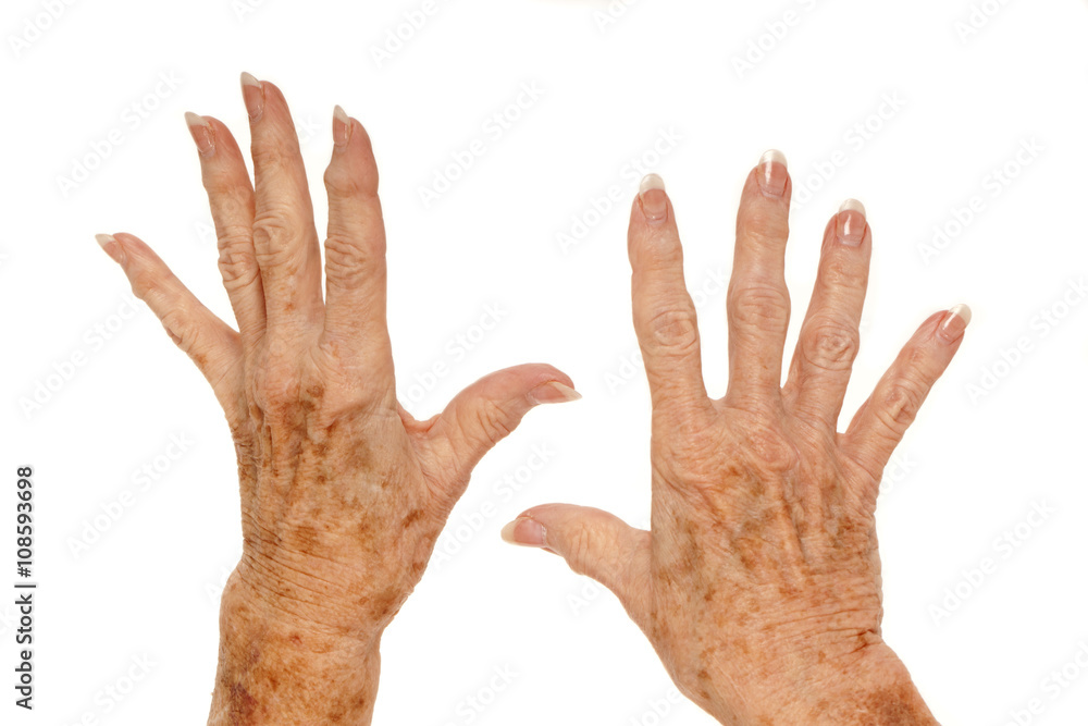 Medical: Female senior citizen hand with Rheumatoid Arthritis and age ...