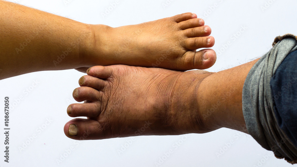 Above the feet of obese people. Stock Photo | Adobe Stock