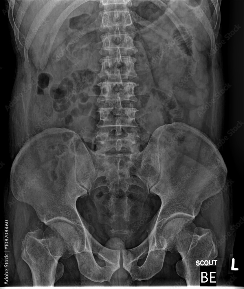 X-ray lumbo-sacral spine and pelvis Stock Photo | Adobe Stock
