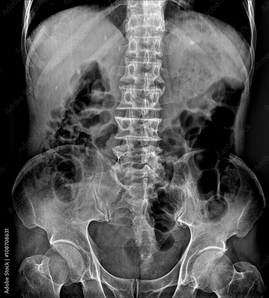 X-ray lumbo-sacral spine and pelvis Stock Photo | Adobe Stock