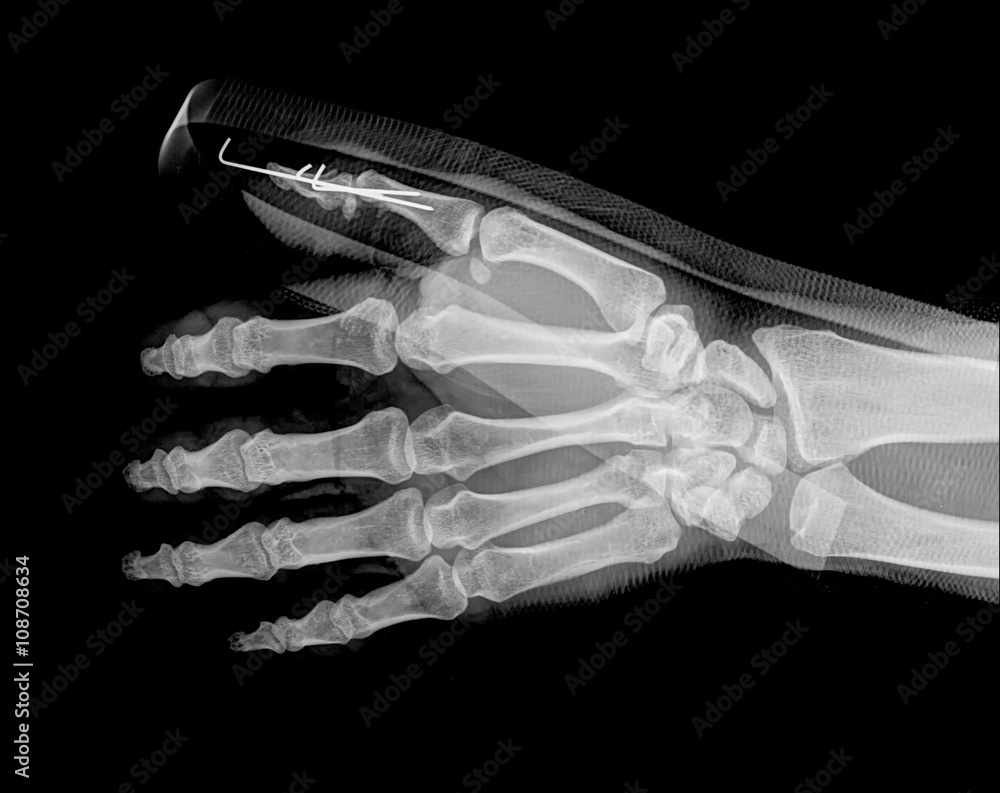 Broken hand after external fixation on roentgenogram Stock Photo ...