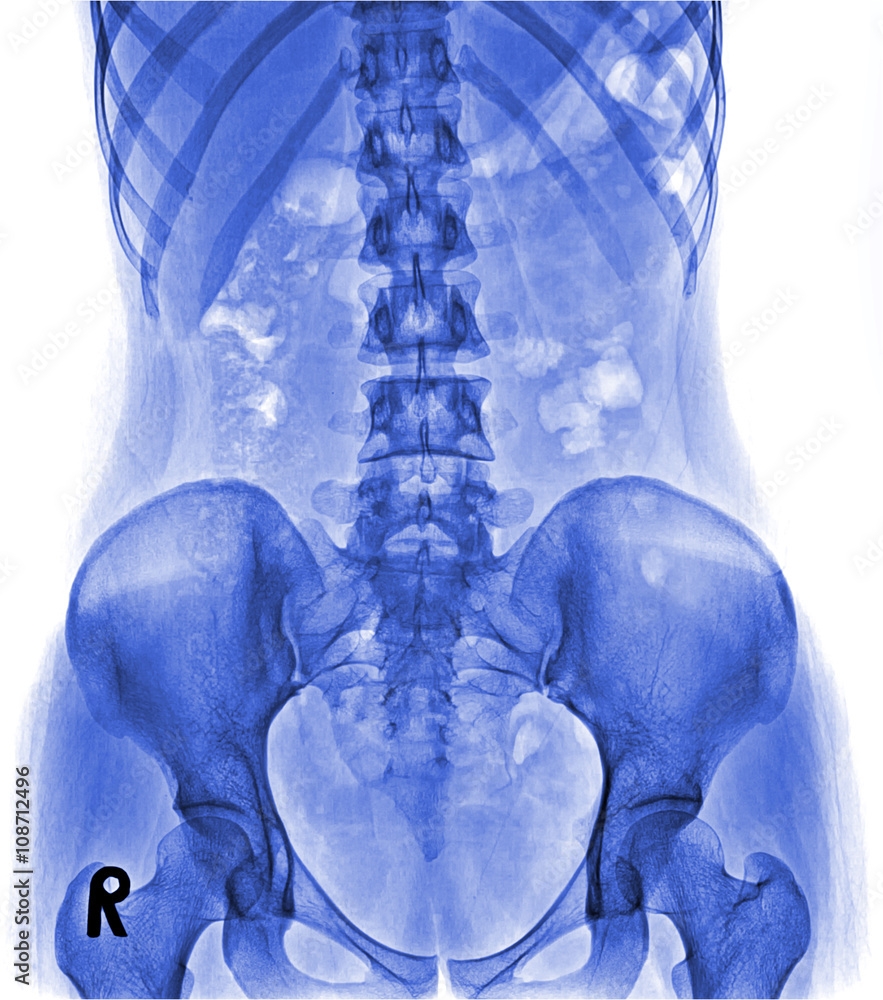 X-ray lumbo-sacral spine and pelvis Stock Photo | Adobe Stock