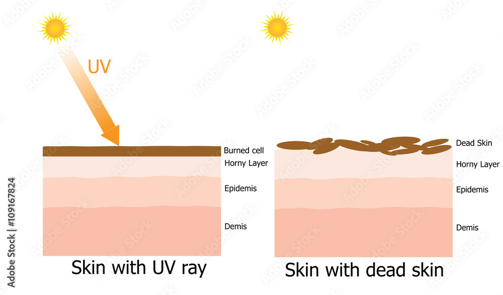 Infographic about dead skin on human skin by UV ray Stock Vector ...
