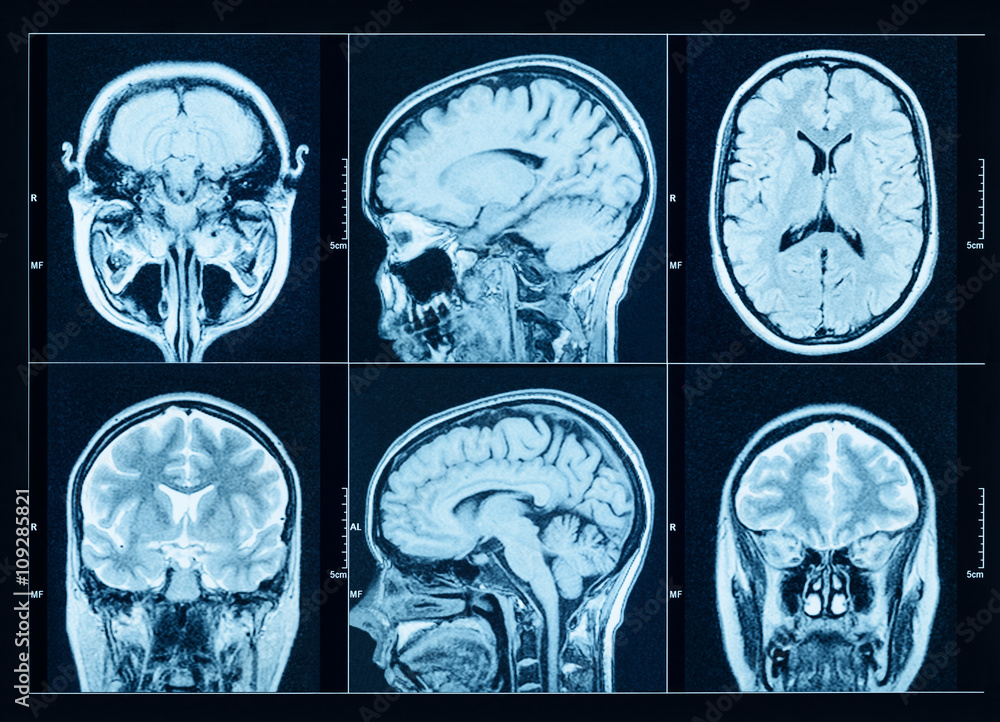 Closeup of a CT scan with brain 素材庫相片 | Adobe Stock
