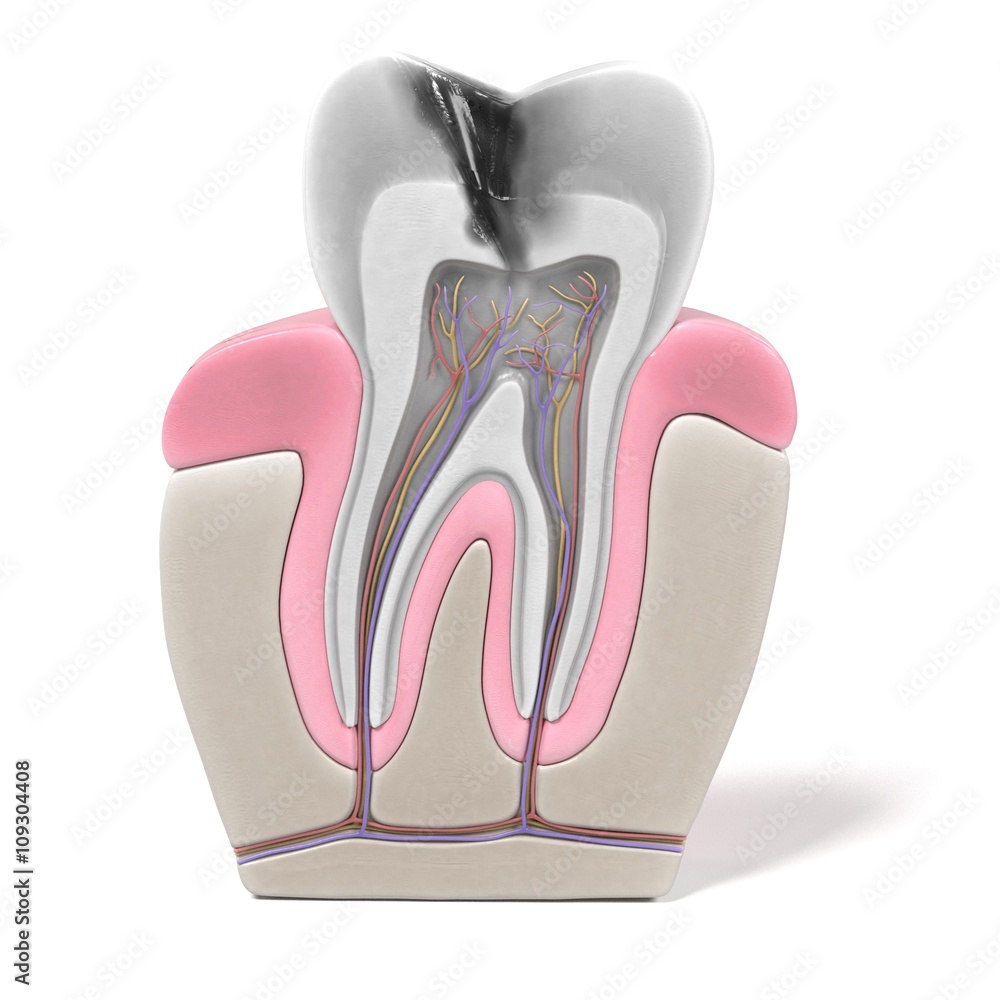 3d renderings of endodontics - root canal procedure Stock Illustration ...