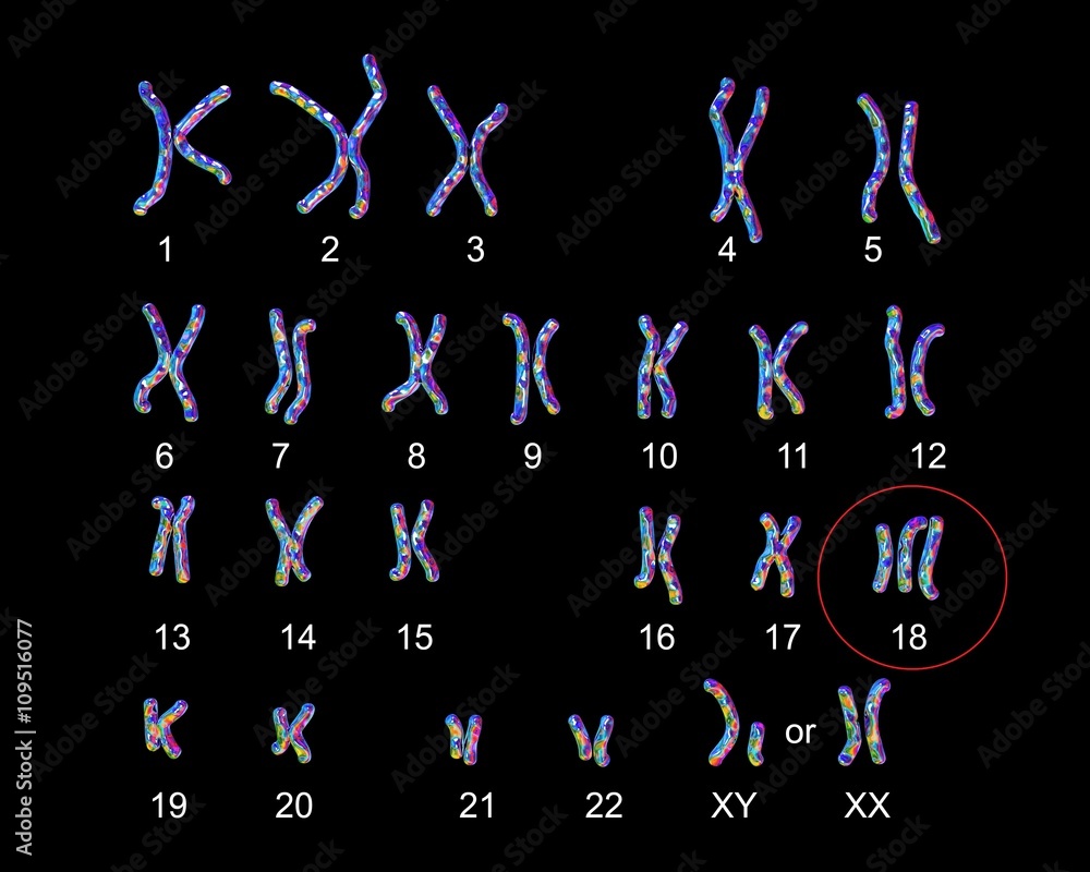 Edwards-syndrome karyotype, labeled. Trisomy 18. 3D illustration Stock ...