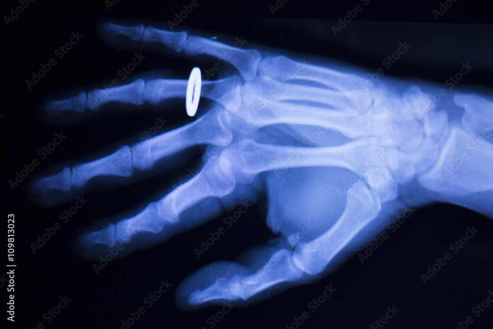Xray Of Broken Finger