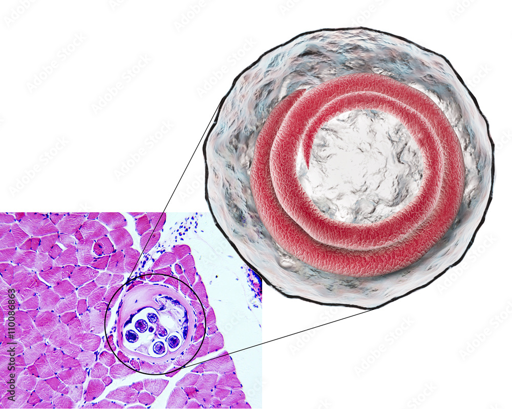 3D illustration and microphotograph (transverse section) of cyst in ...