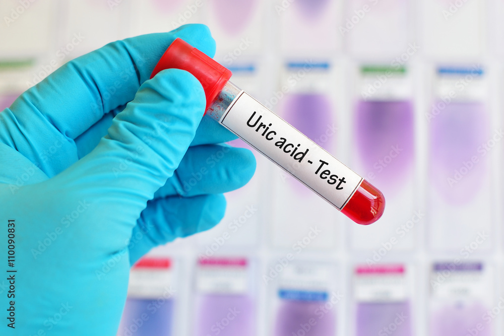 Blood sample for uric acid test, gouty arthritis diagnosis Stock Photo ...