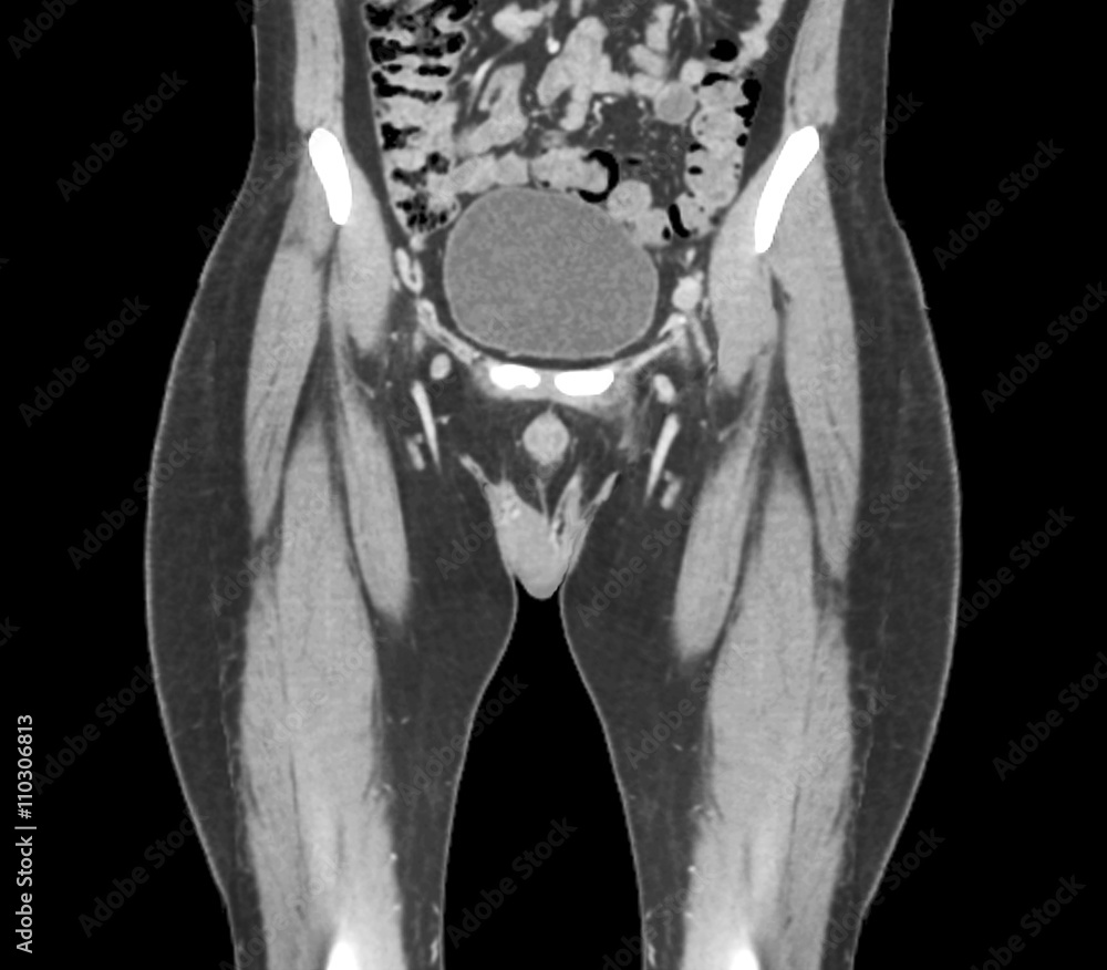 Healthy bladder, CT scan Stock 写真 | Adobe Stock