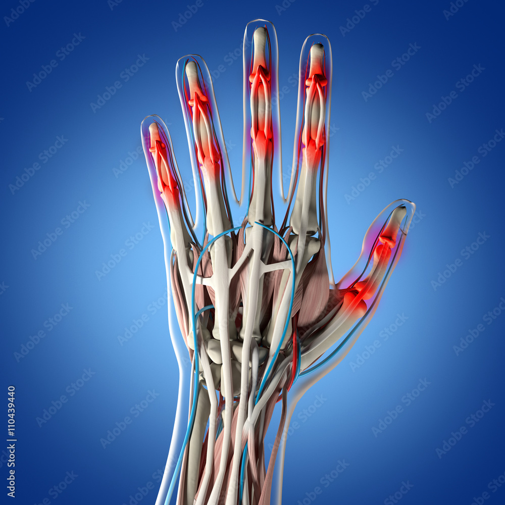 Human anatomy hand, arthritis, joint pain in fingers. 3D Illustration ...