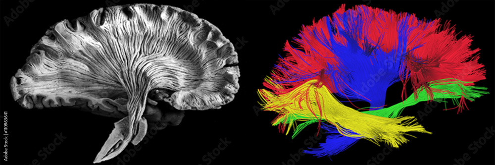 Sagittal, side view. Left - picture of a human brain dissection by a ...