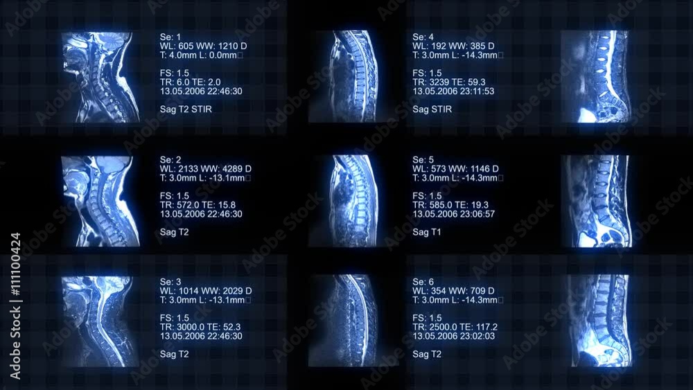 4k set of spine MRI, real animated tomography of the spine, Magnetic ...